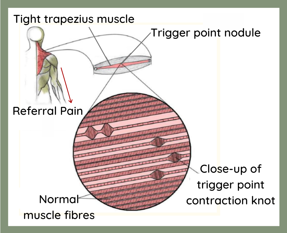 What's Triggering Your Pain? — Creative Chiro Chiropractor Fakenham ...