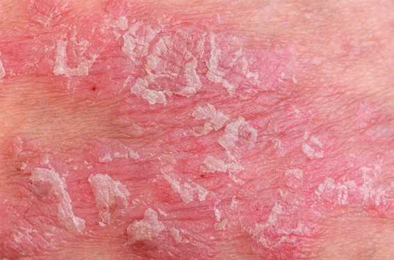 Psoriasis Treatment Sydney Dermatologist — Northern Sydney Dermatology ...