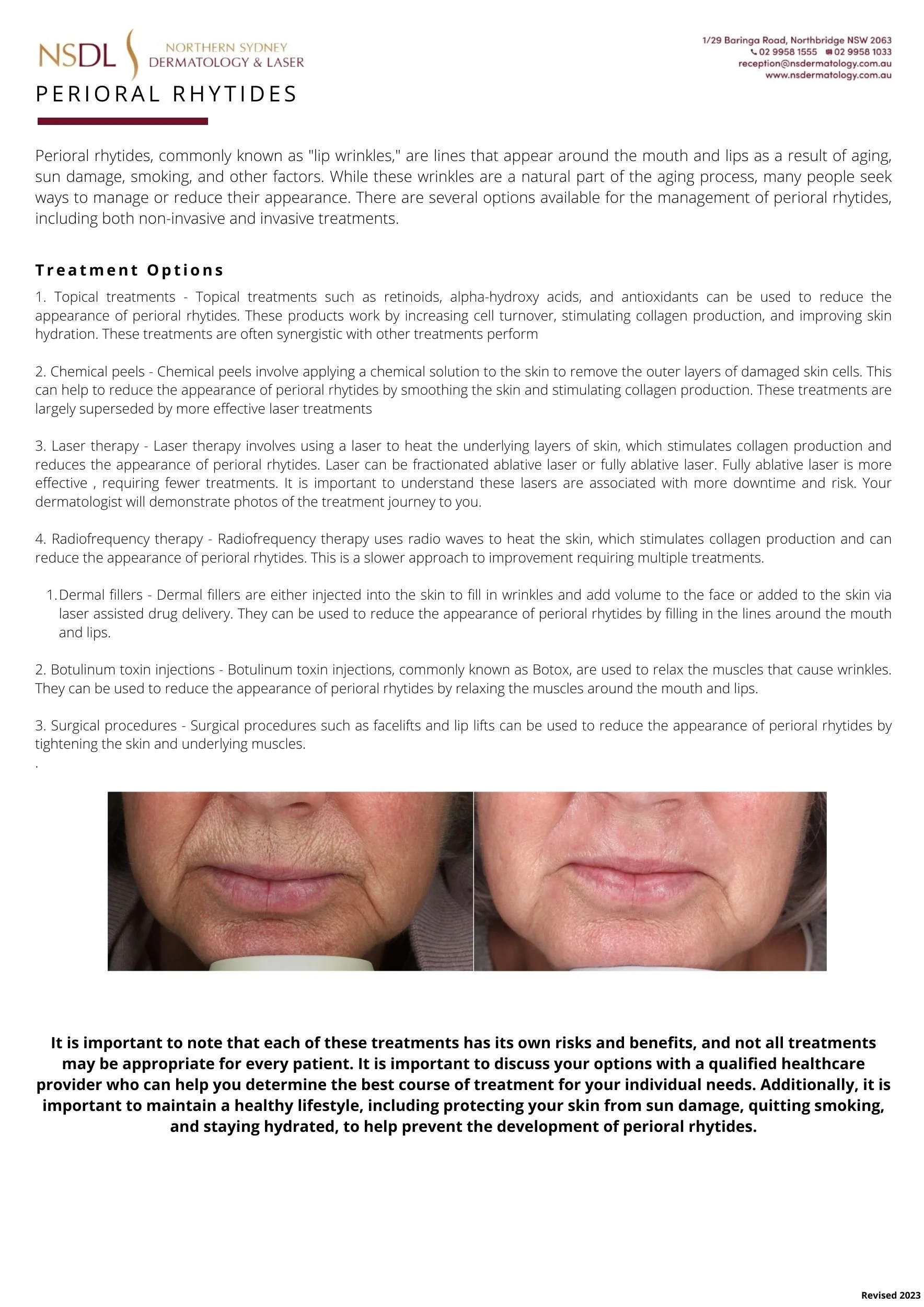 Perioral Rhytides — Northern Sydney Dermatology & Laser | Sydney North ...