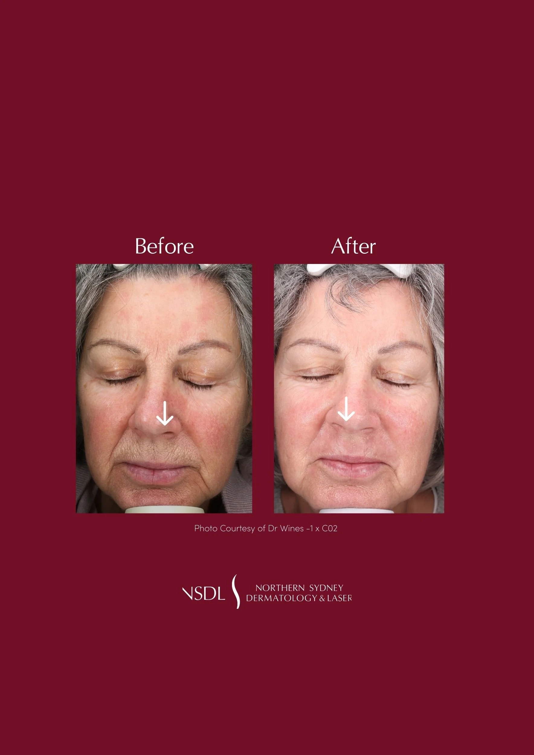 Perioral Rhytides — Northern Sydney Dermatology & Laser | Sydney North ...