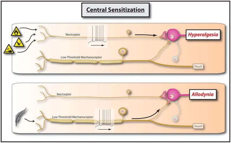 Article - Central Sensitization - Header — NEURO NEW ME