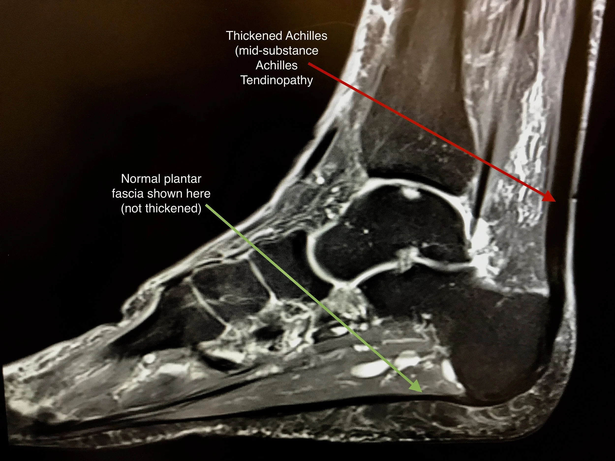 MBT Plantar Fasciitis Plantar Fasciitis Treatment David Redfern MBT Plantar Fasciitis Plantar Fasciitis Treatment David Redfern