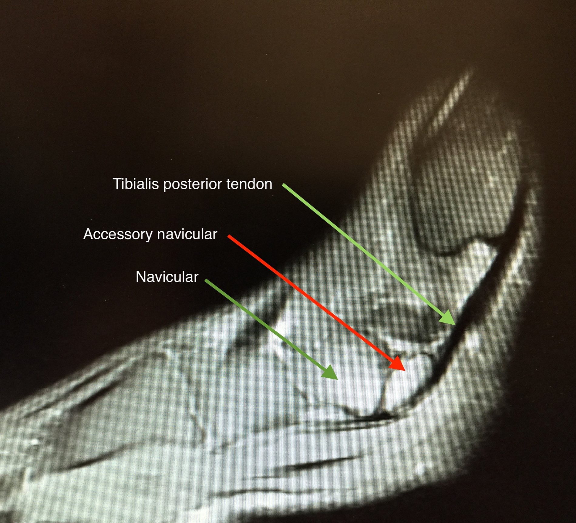 Posterior Tibial Tendon Mri Posterior Tibial Tendon Mri