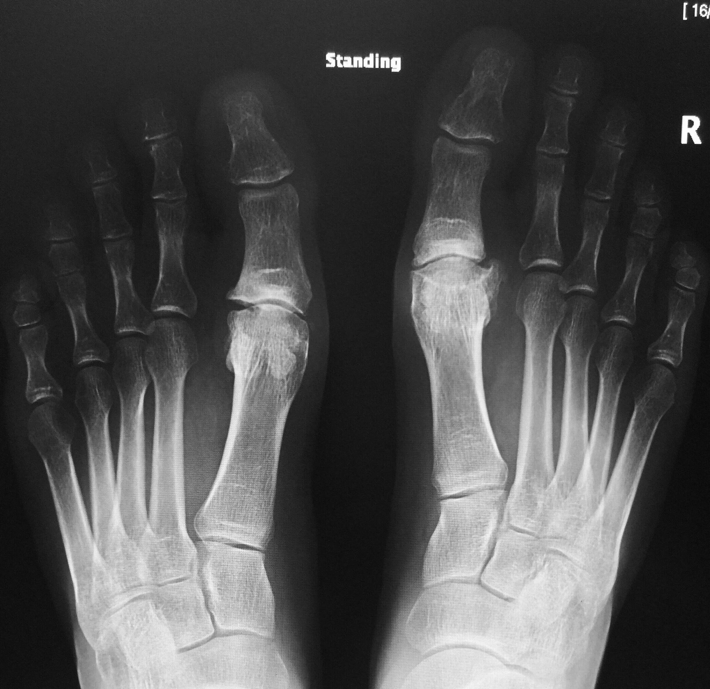 Big Toe Arthritis | Arthritis Treatment & Surgery | David Redfern