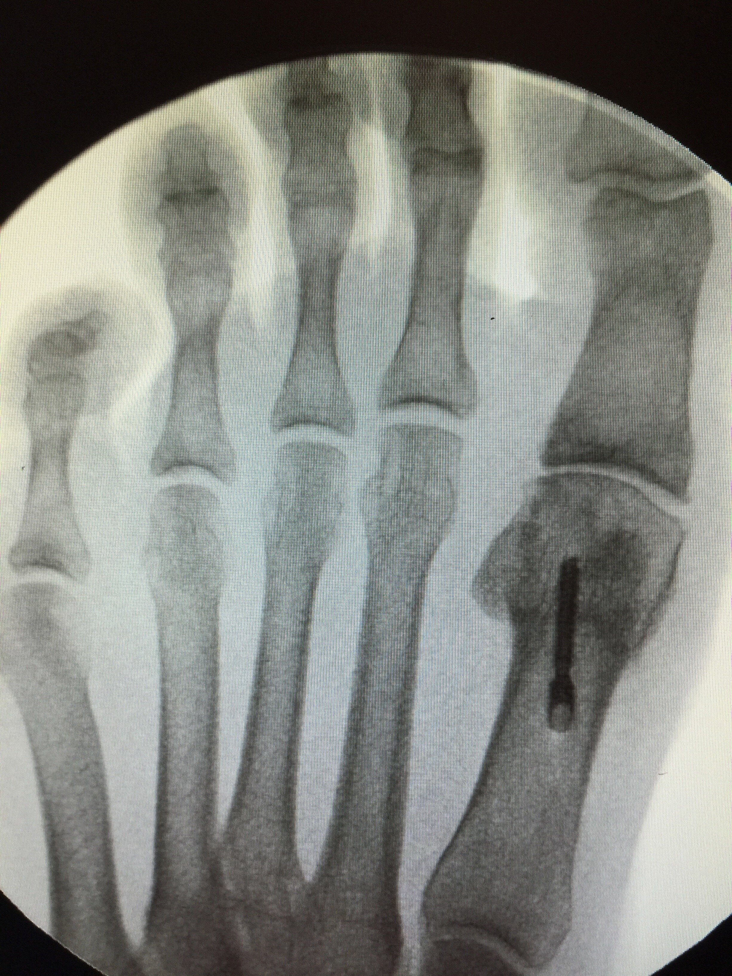 Minimally invasive Hallux Rigidus Osteotomy — David Redfern Surgery