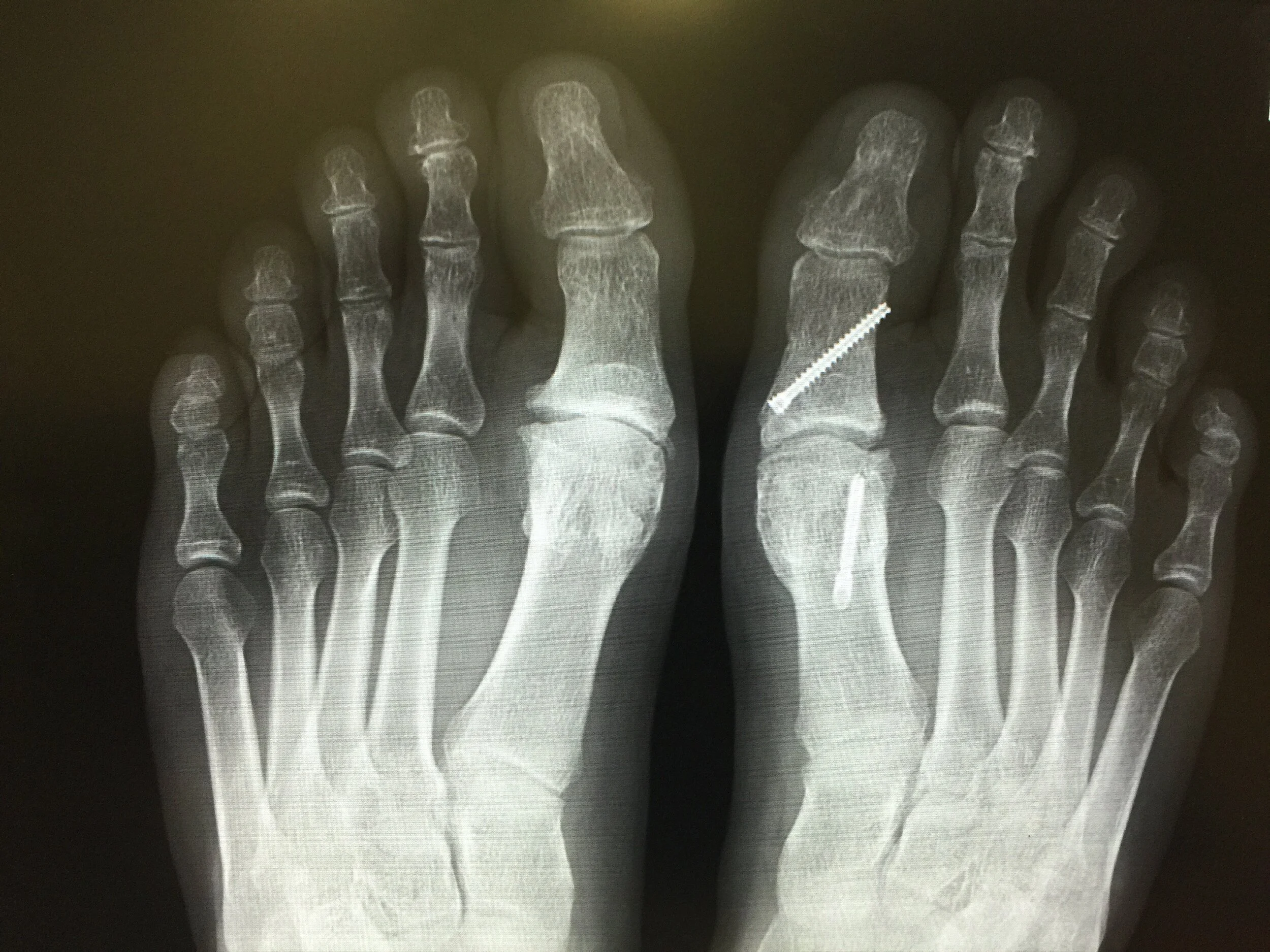 Minimally invasive Hallux Rigidus Osteotomy — David Redfern Surgery