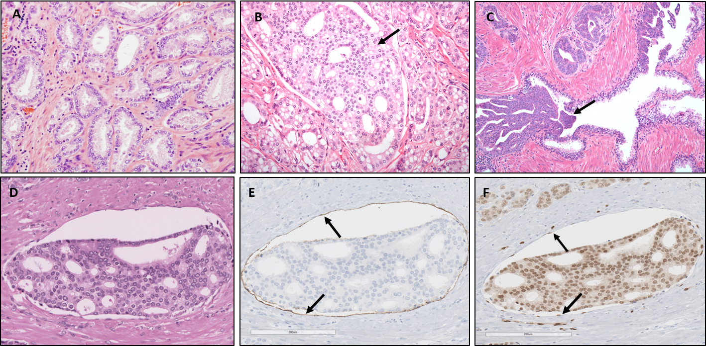 Prostate Cancer Pathology