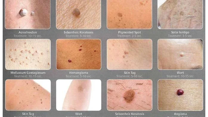 New Cryoprobe for treatment of precancerous lesions in the comfort of ...