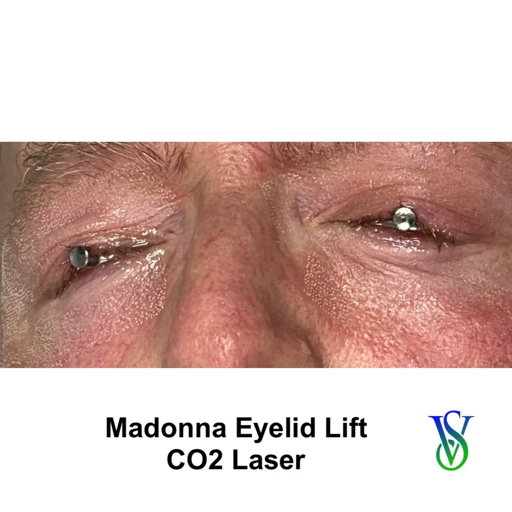 Laser Eyelid Lift