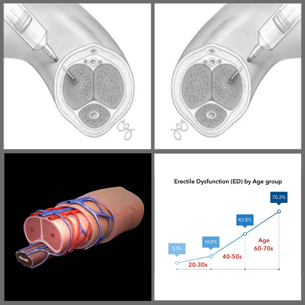 PRF/(P) Penis shot | Vida Skin Beauty Center