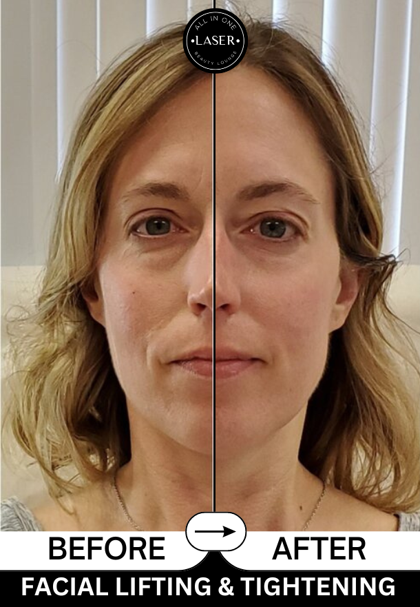 FACIAL SKIN TIGHTENING — ALL IN ONE LASER