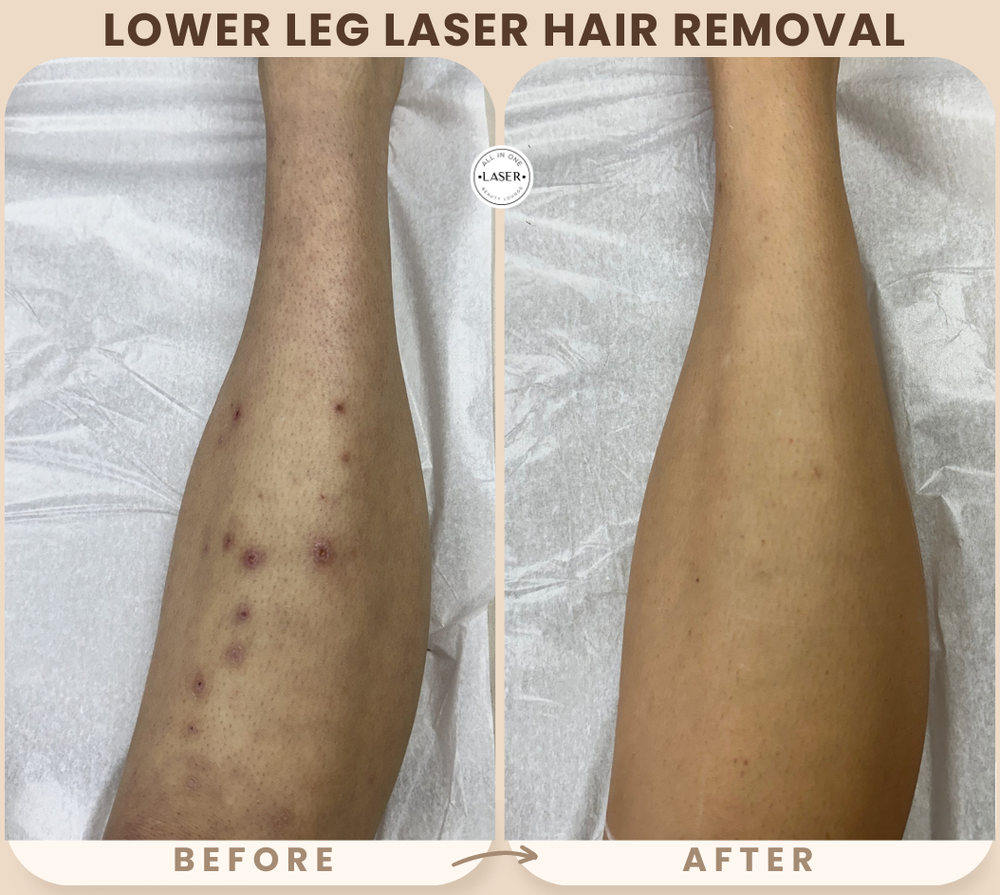 LASER HAIR REMOVAL — ALL IN ONE LASER