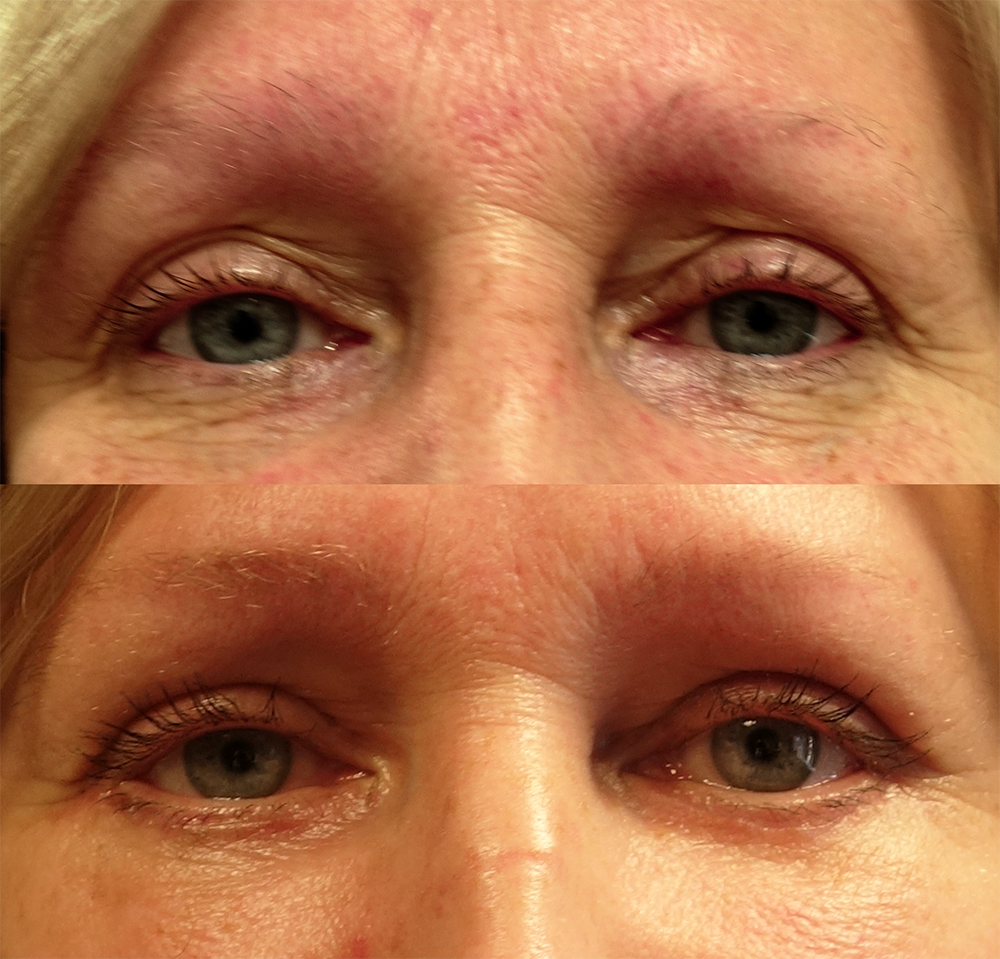BLEPHAROPLASTY, SURGICAL COSMETIC PROCEDURE, ETON — Eterno 360° | Plastic Surgery & Cosmetic ...