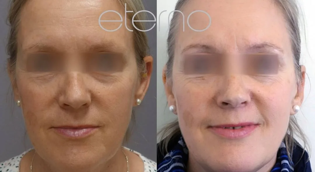 PROMINENT EAR CORRECTION, , SURGICAL COSMETIC PROCEDURE, ETON — Eterno ...