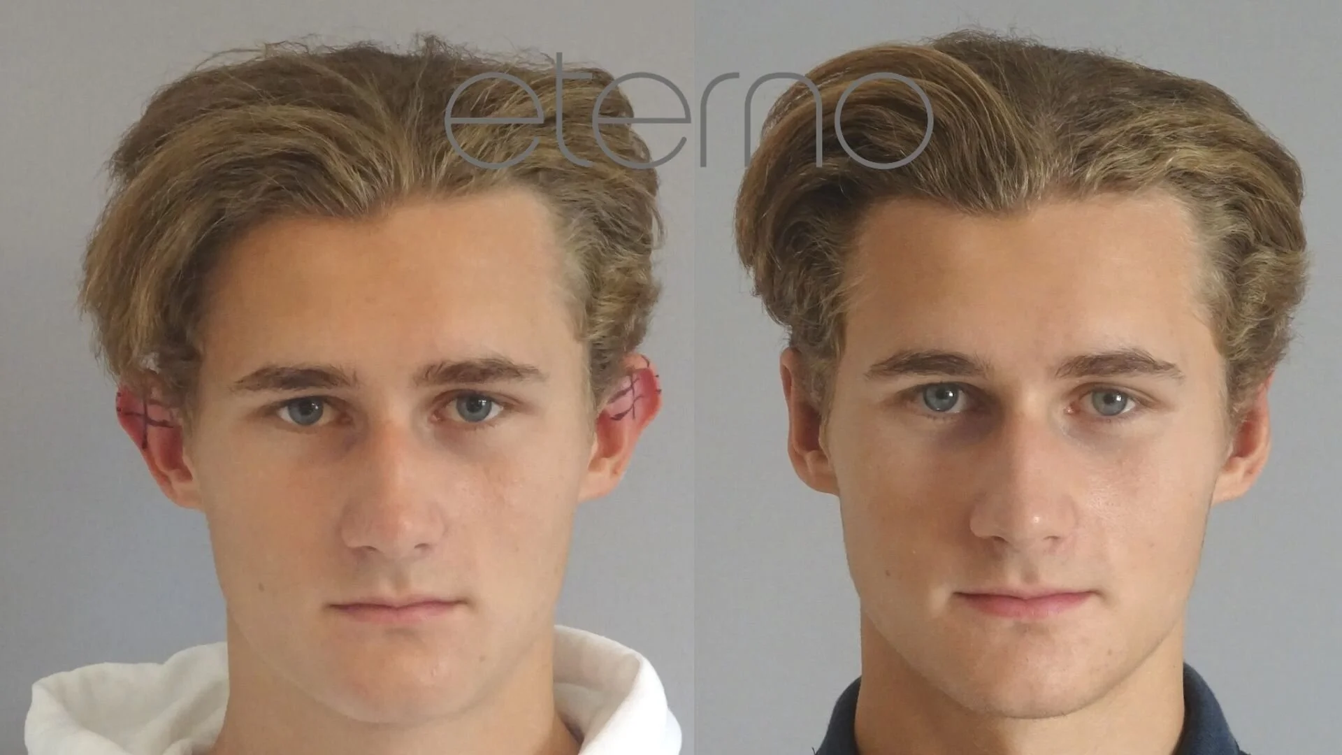 PROMINENT EAR CORRECTION, , SURGICAL COSMETIC PROCEDURE, ETON — Eterno ...