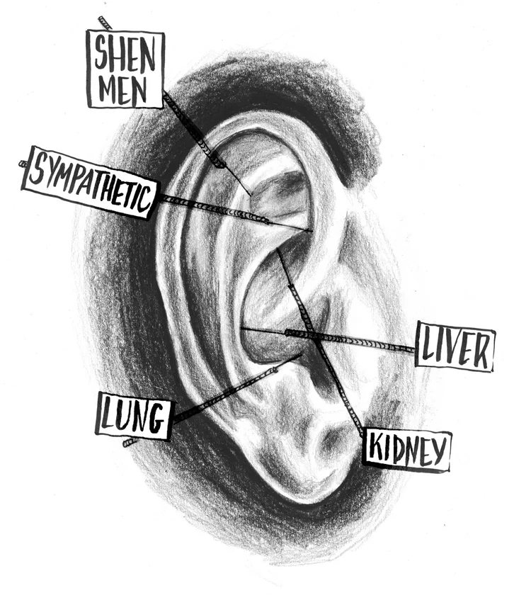 The 5 points of the NADA Protocol — Acupuncture for Community : Simple ...
