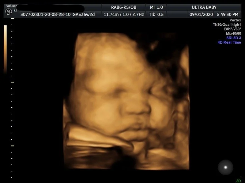 10 Week 3d Ultrasound Pictures