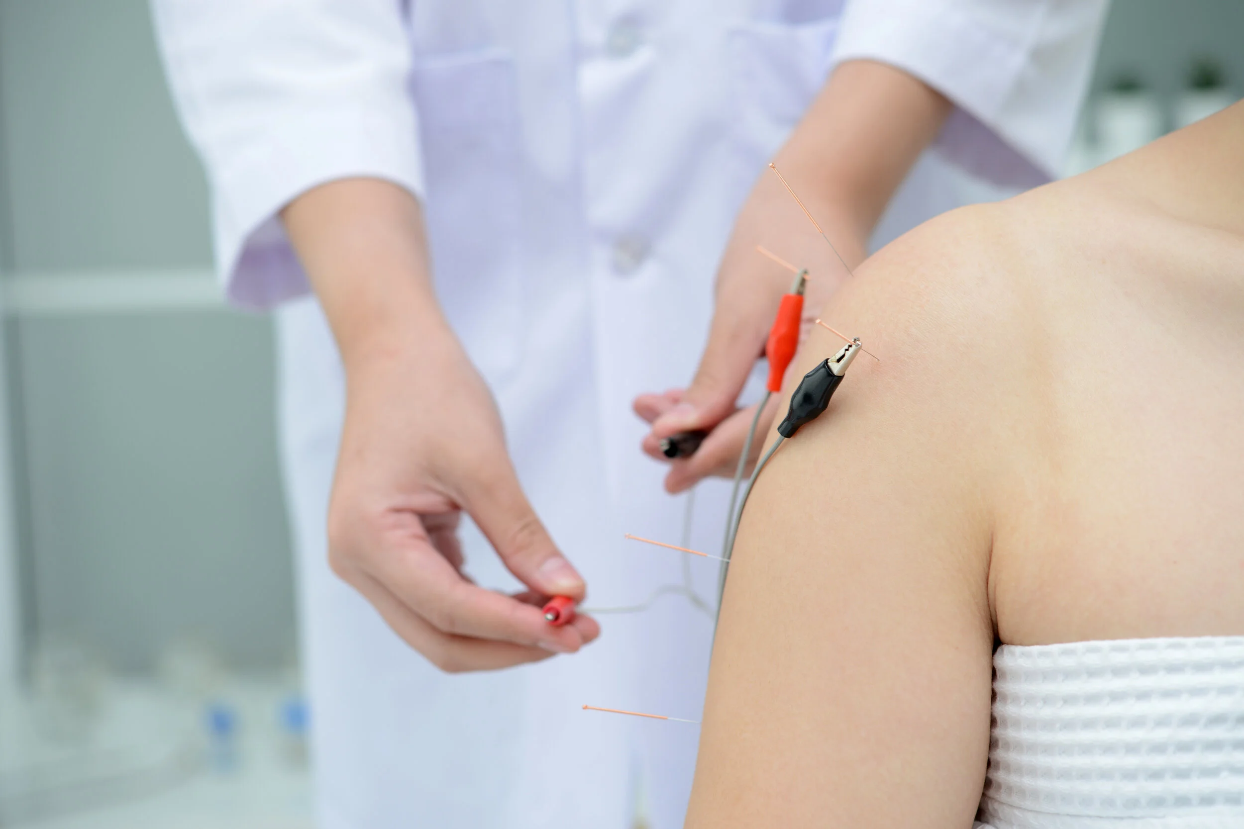 Electroacupuncture — AcuPremier Acupuncture