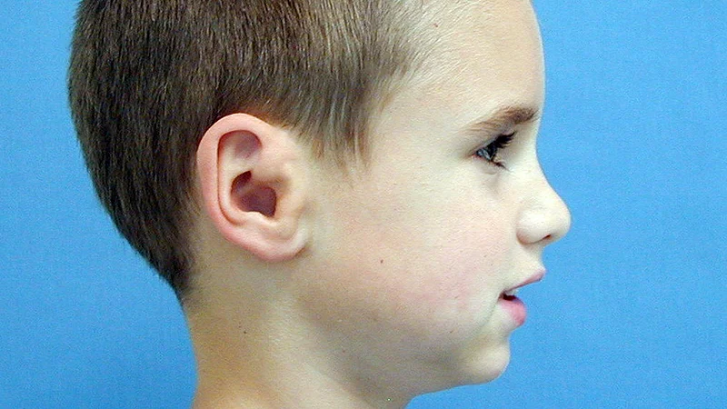 Wisconsin Prosthetic Restoration — Life-like Prosthetics