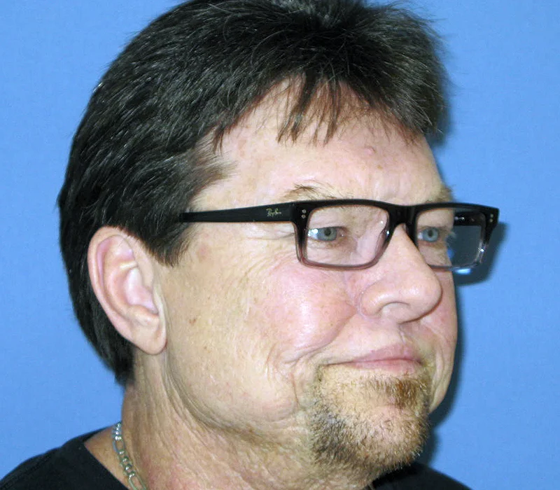Nasal Prosthesis - Prosthetic Nose | Wisconsin — Life-like Prosthetics