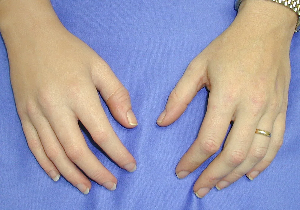 Finger Prosthesis - Hand Prosthesis | Milwaukee, WI — Life-like Prosthetics