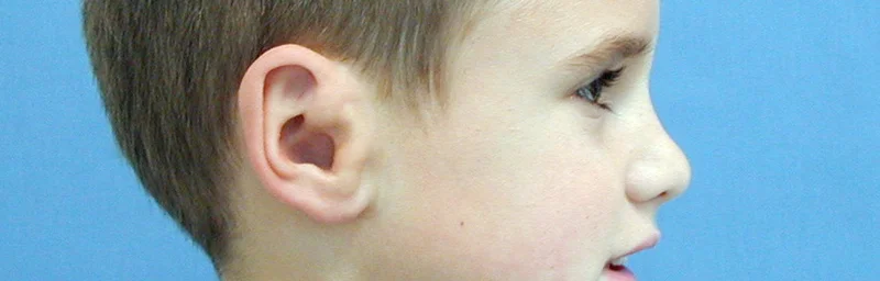 Prosthetic Ear - Ear Prosthesis - Microtia | Wisconsin — Life-like ...