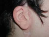 Prosthetic Ear - Ear Prosthesis - Microtia | Wisconsin — Life-like ...