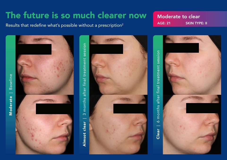 Mild Moderate Severe Acne