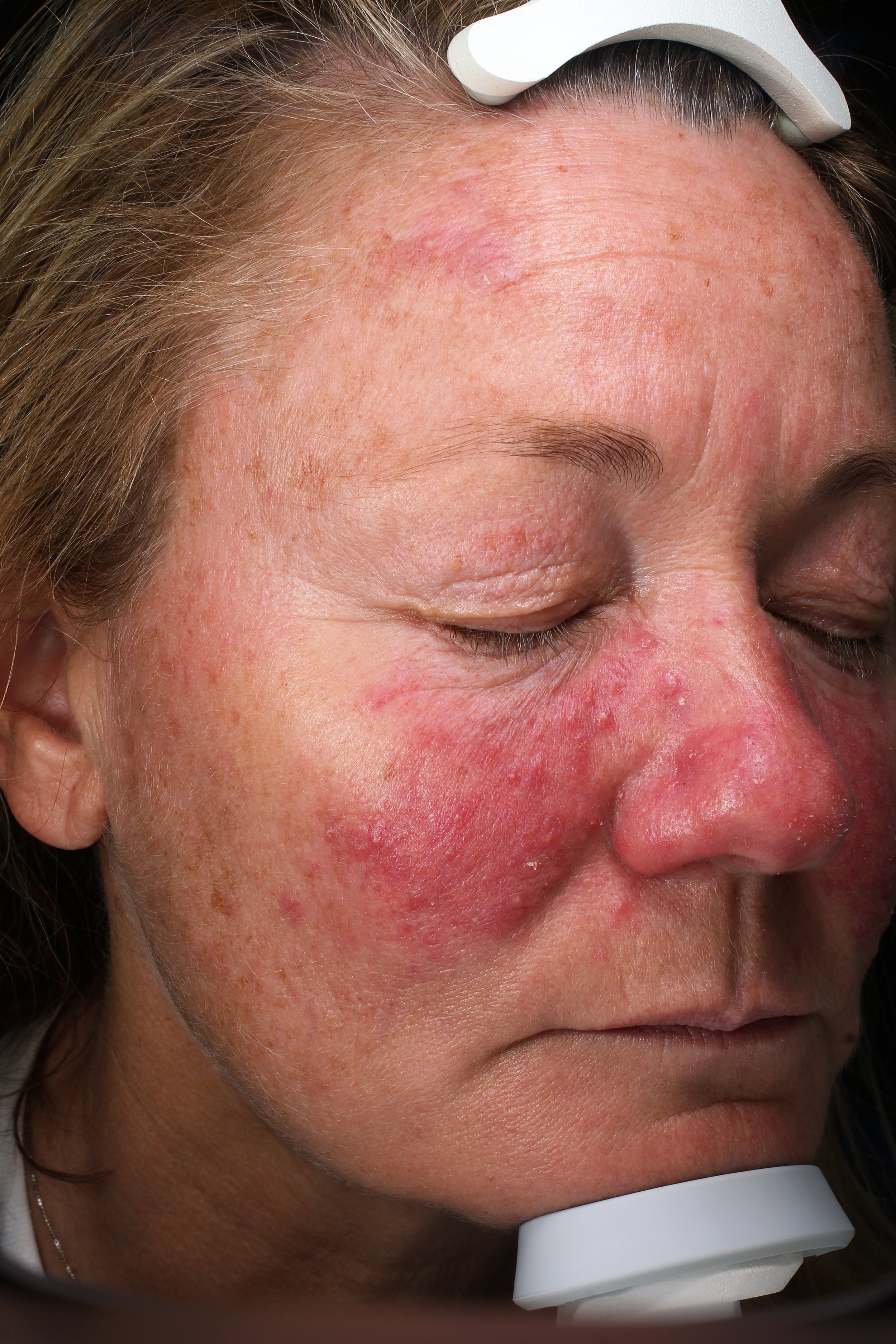 Redness And Rosacea Northbridge Dermatology Dr Nina Wines — Dr Nina