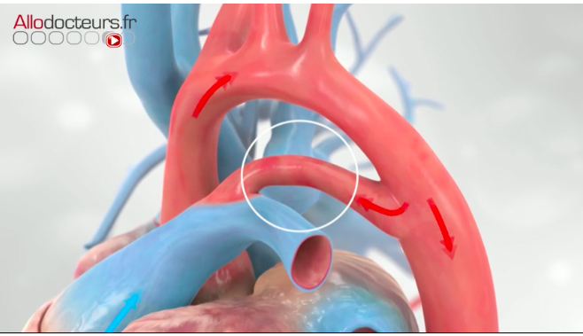 Le Piccolo, l’implant cardiaque qui sauve les bébés prématurés ...