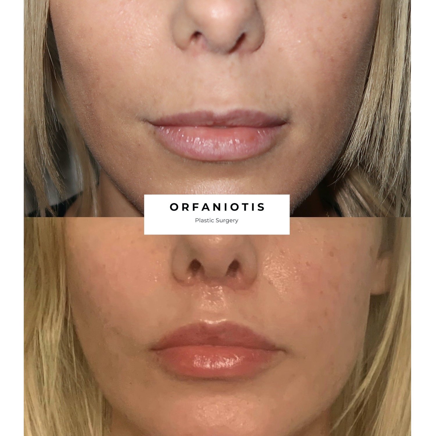 Lip Lift Surgery: Rejuvenating the Lower Face in London