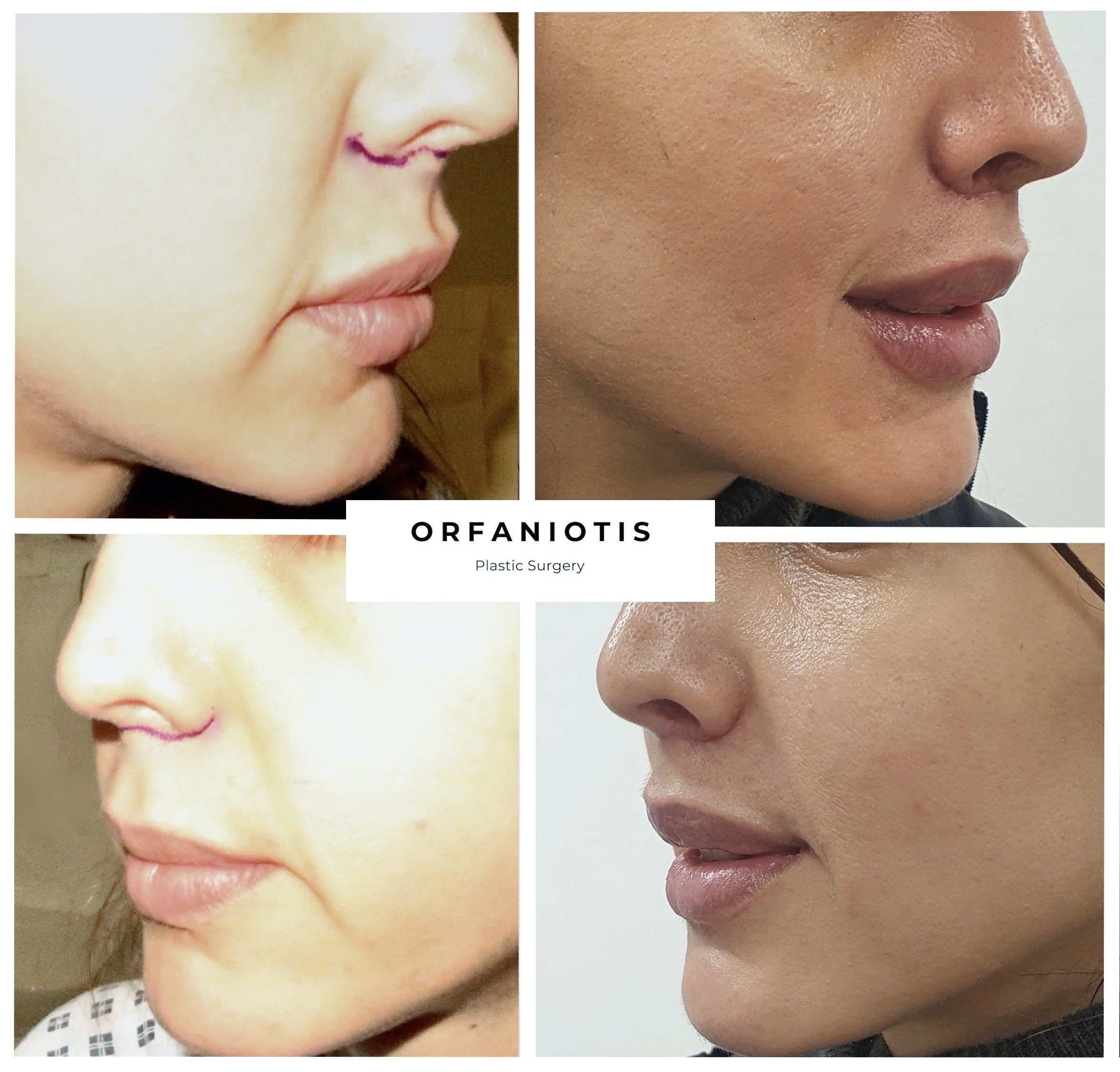 Lip Lift Before and After Gallery
