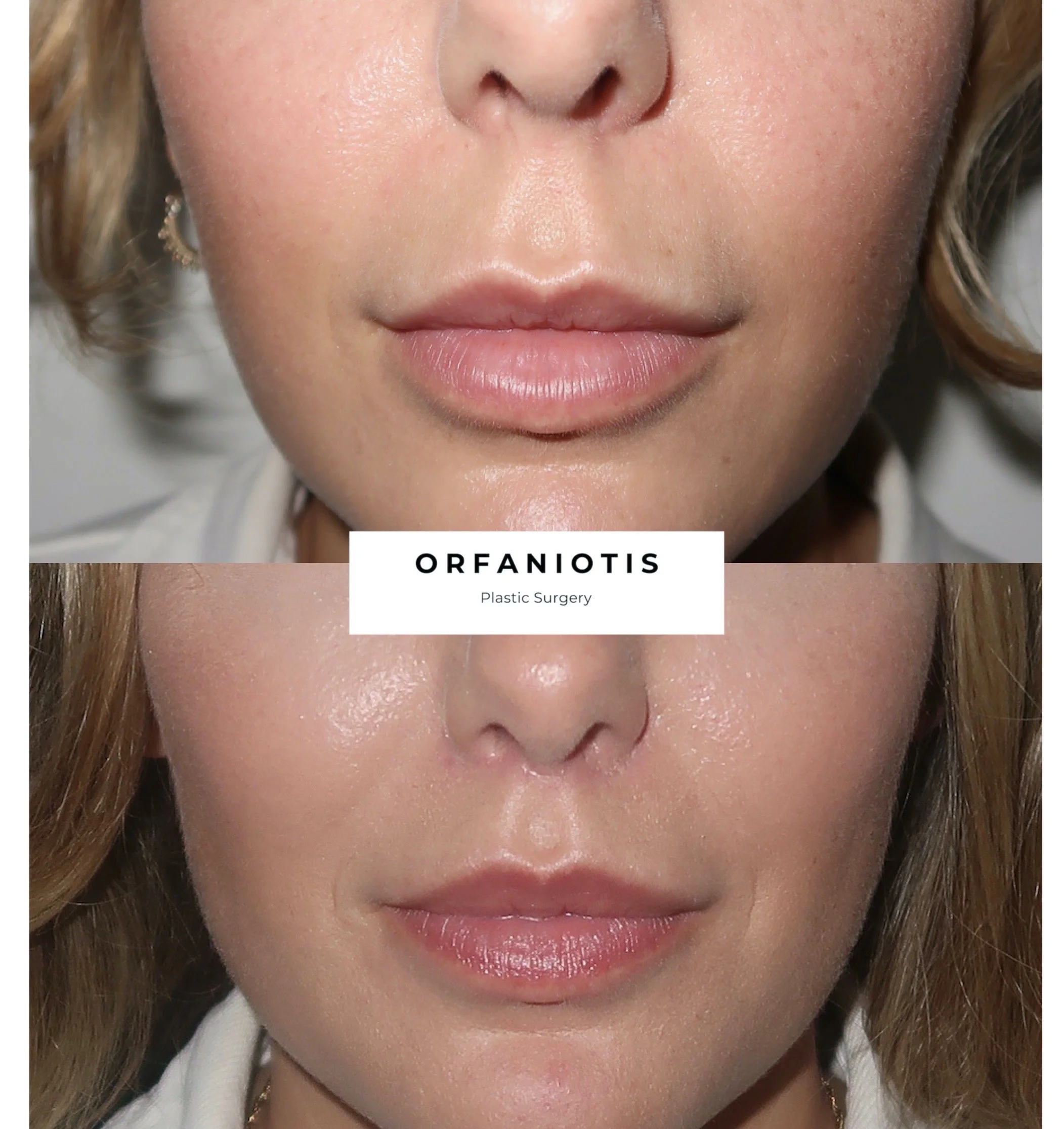 Lip Lift Before and After Gallery