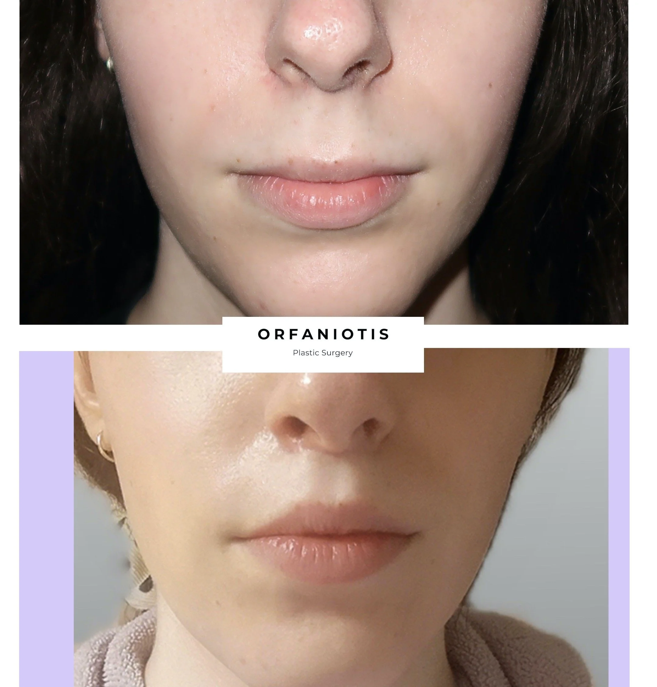Lip Lift Before and After Gallery