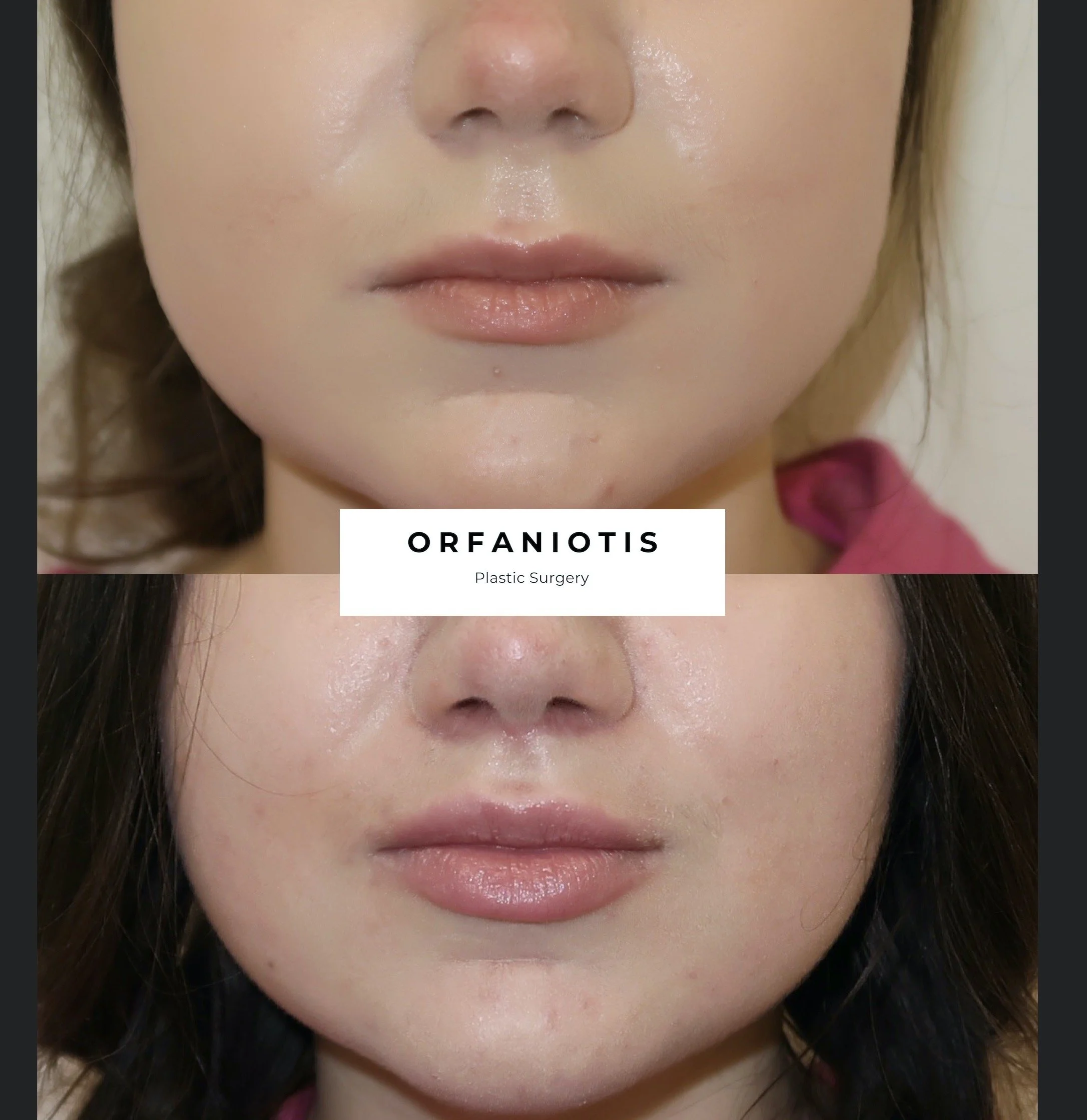 Lip Lift Before and After Gallery