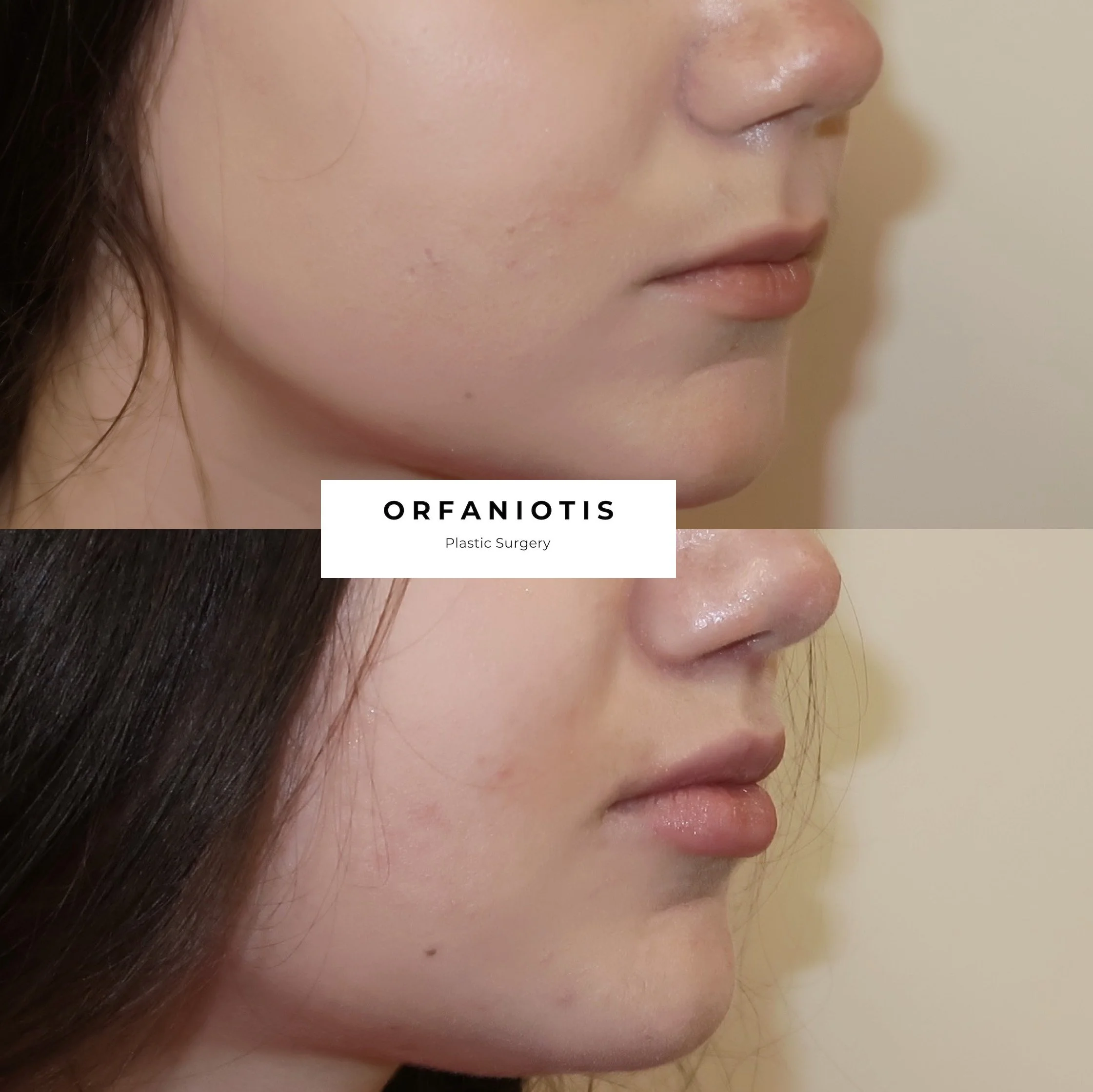 Lip Lift Before and After Gallery