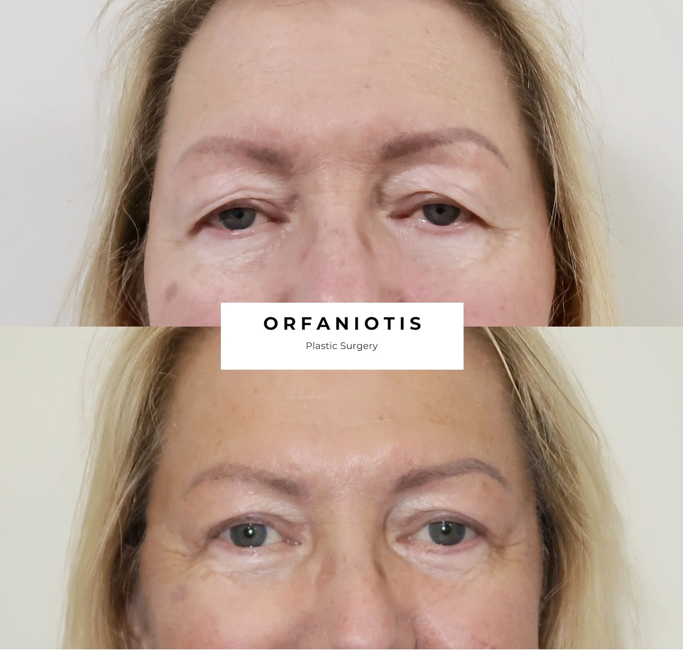 Upper Eyelid Surgery Post Op