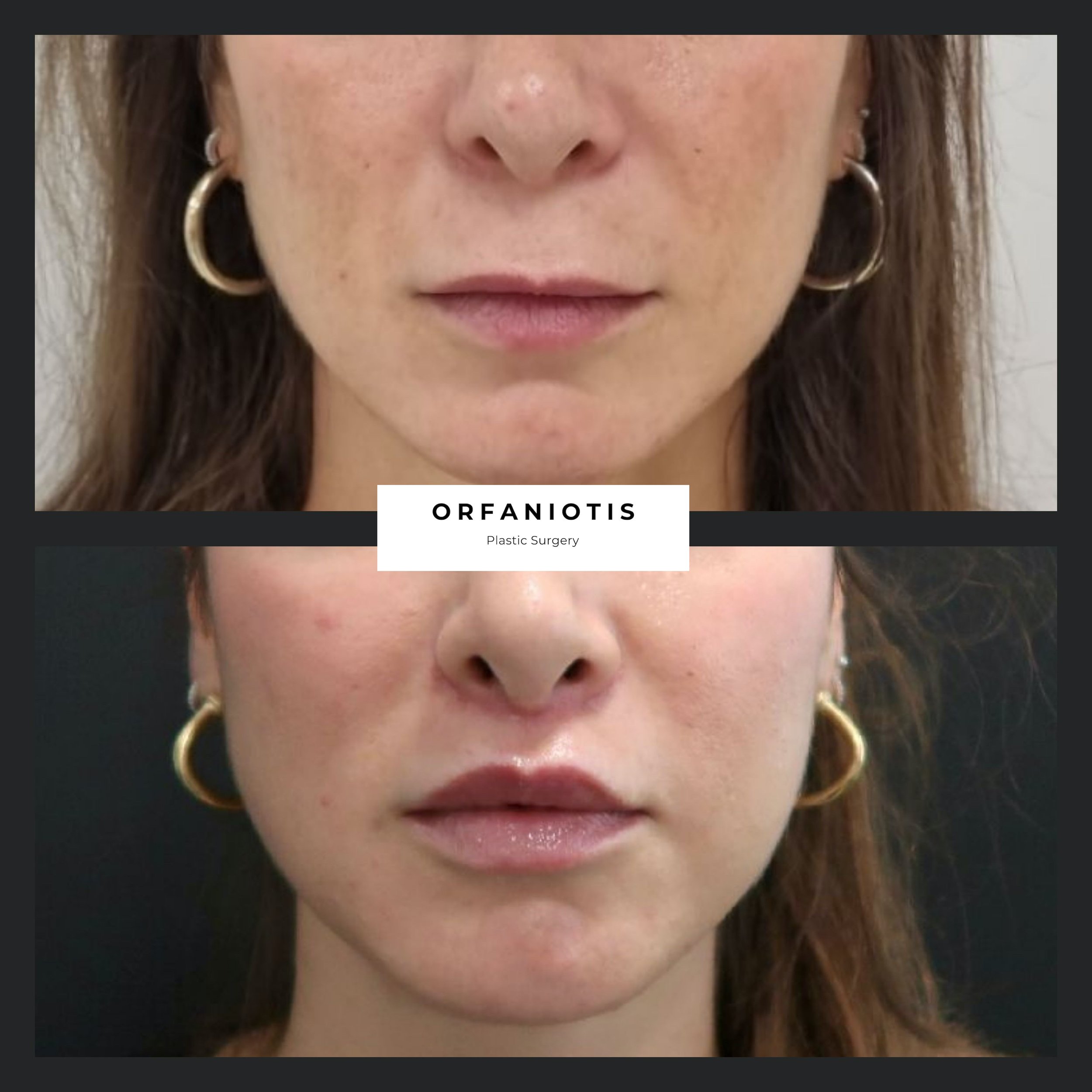 Lip Lift Before and After Gallery