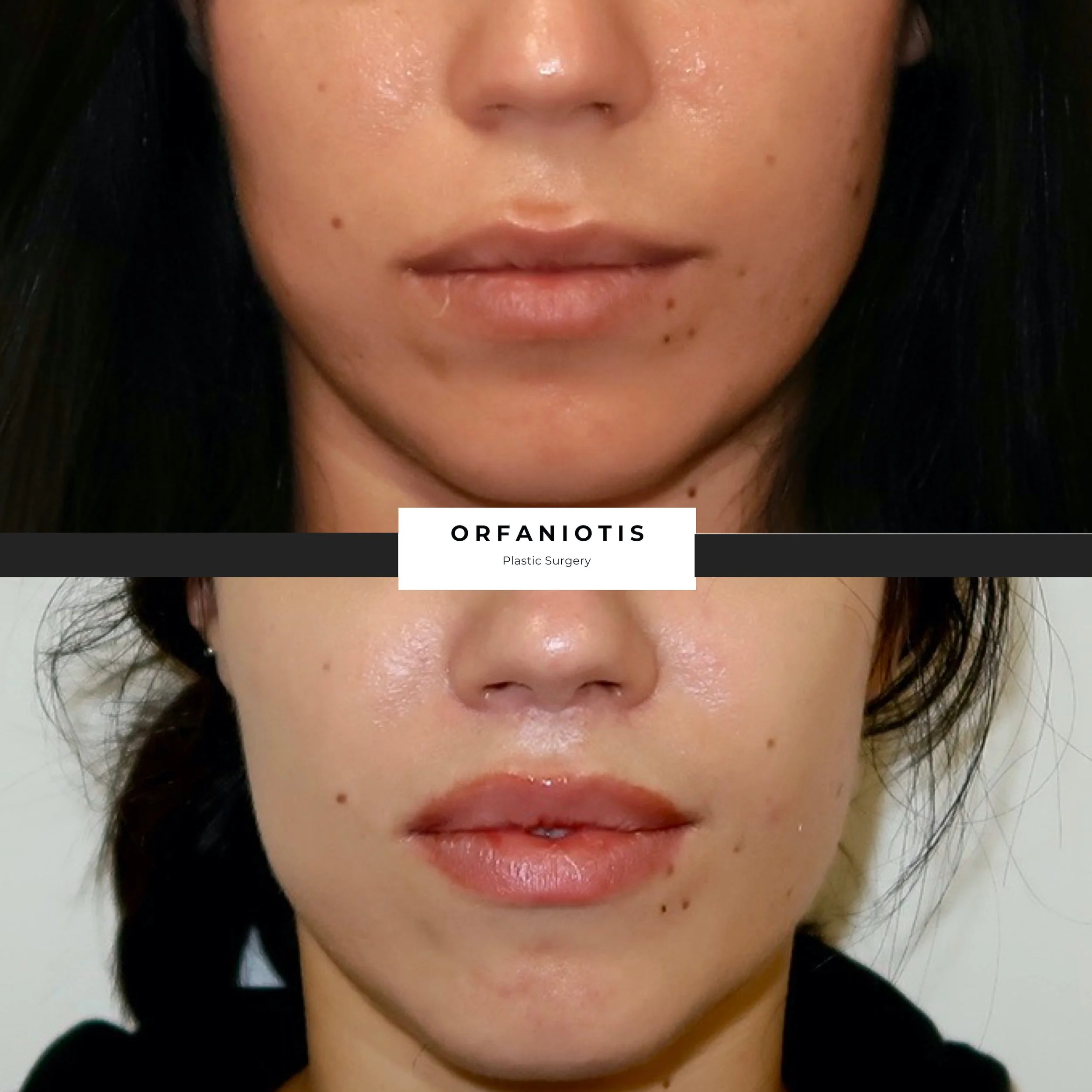 Lip Lift Before and After Gallery