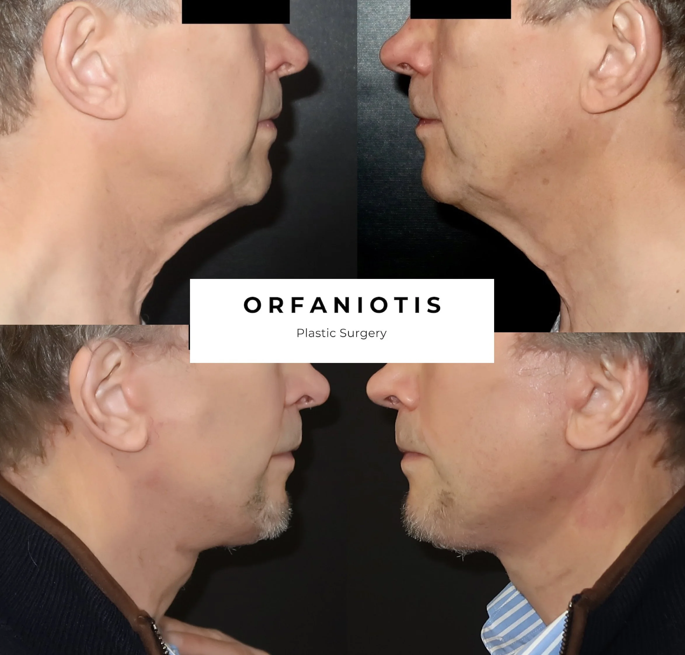 Facelift before & after gallery