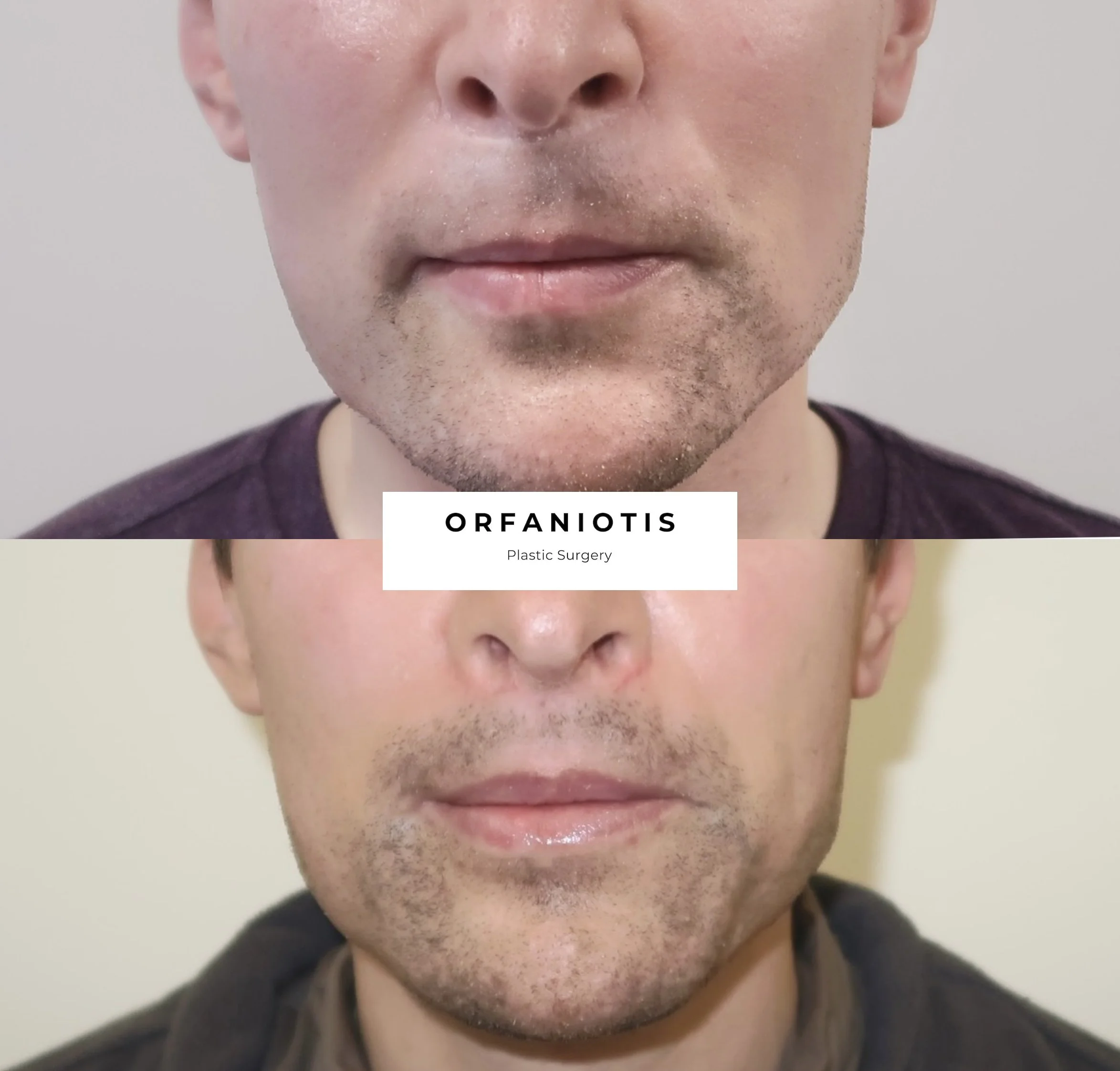 Lip Lift Before and After Gallery