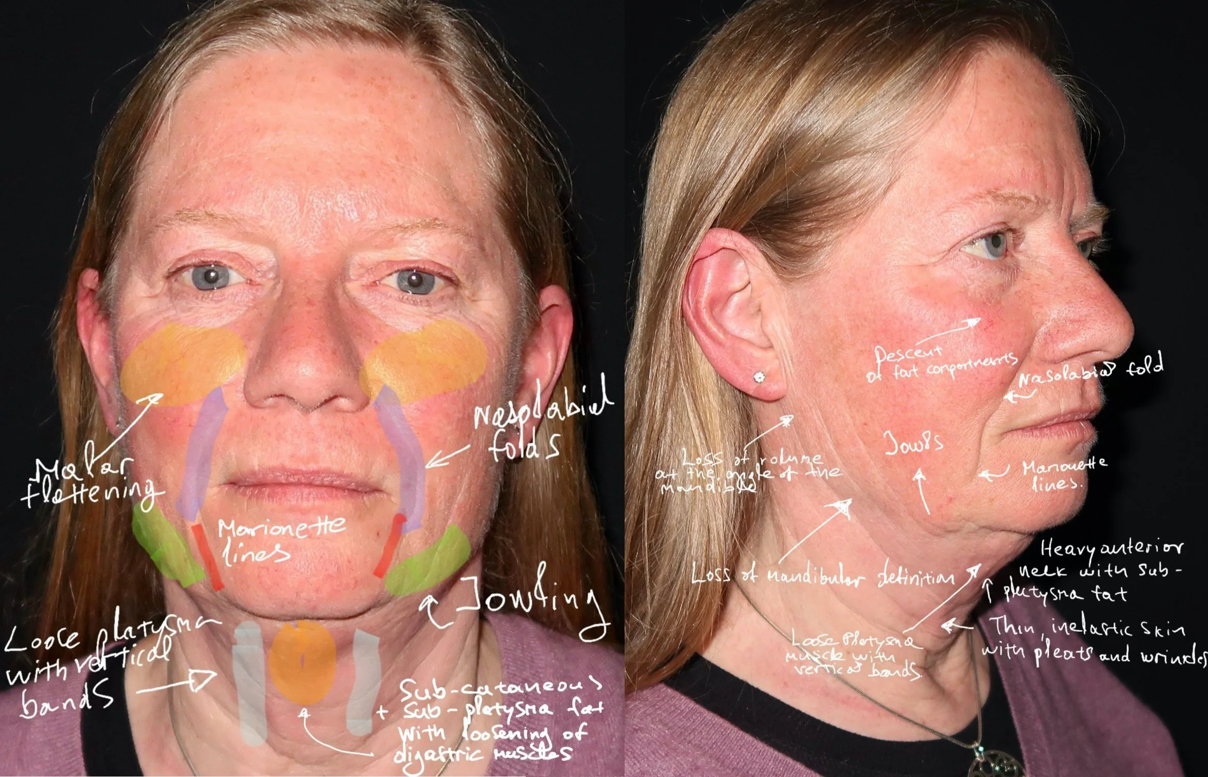 Deep Plane Facelift in London. Georgios Orfaniotis