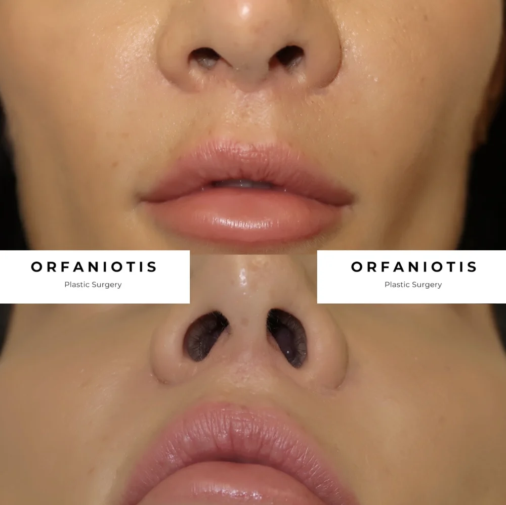 Plastic Surgery Make Lips Smaller | Lipstutorial.org