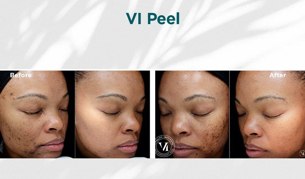 Omaha, NE Chemical Peels | Anti Aging, Scarring & Acne Treatment