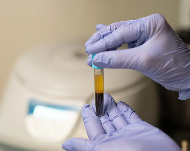 Omaha SkinPen Microneedling | PRP | Anti-Aging and Scar Treatment