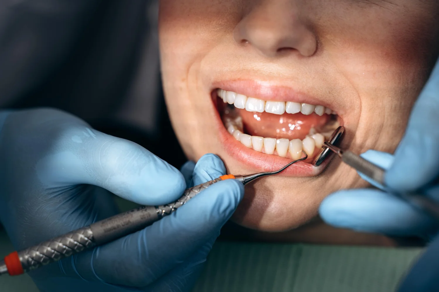 Gingivectomy Explained: A Dentist’s Full Breakdown