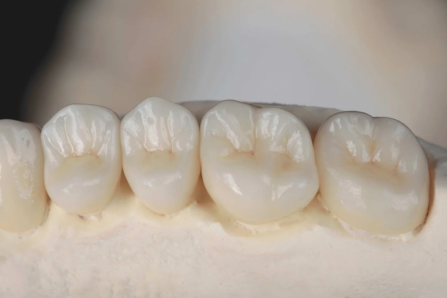 Inlays, Onlays & Crowns Explained