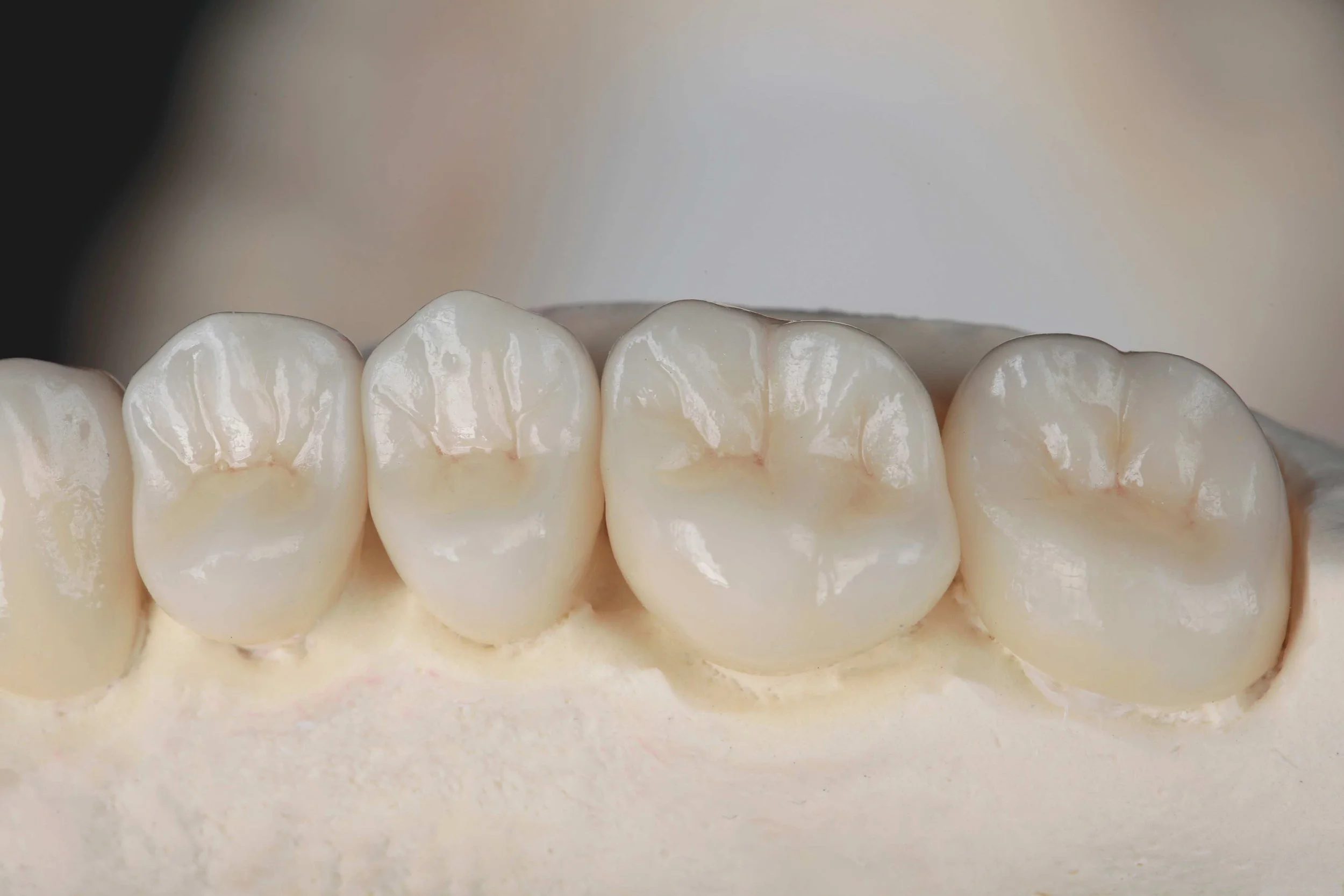 Inlays, Onlays & Crowns Explained