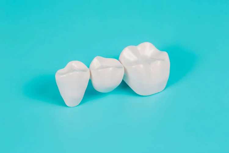 Inlays, Onlays & Crowns Explained