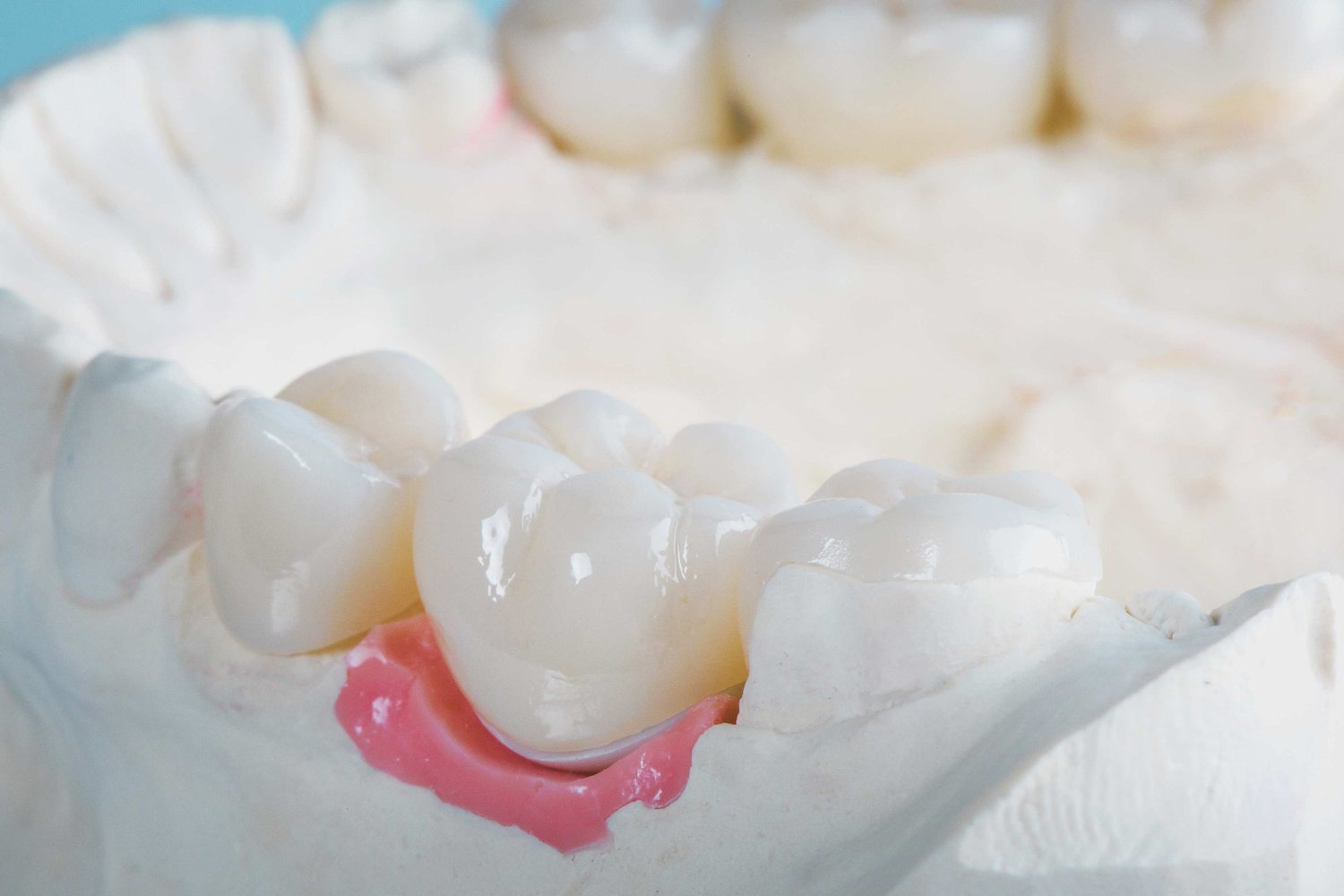 Inlays, Onlays & Crowns Explained